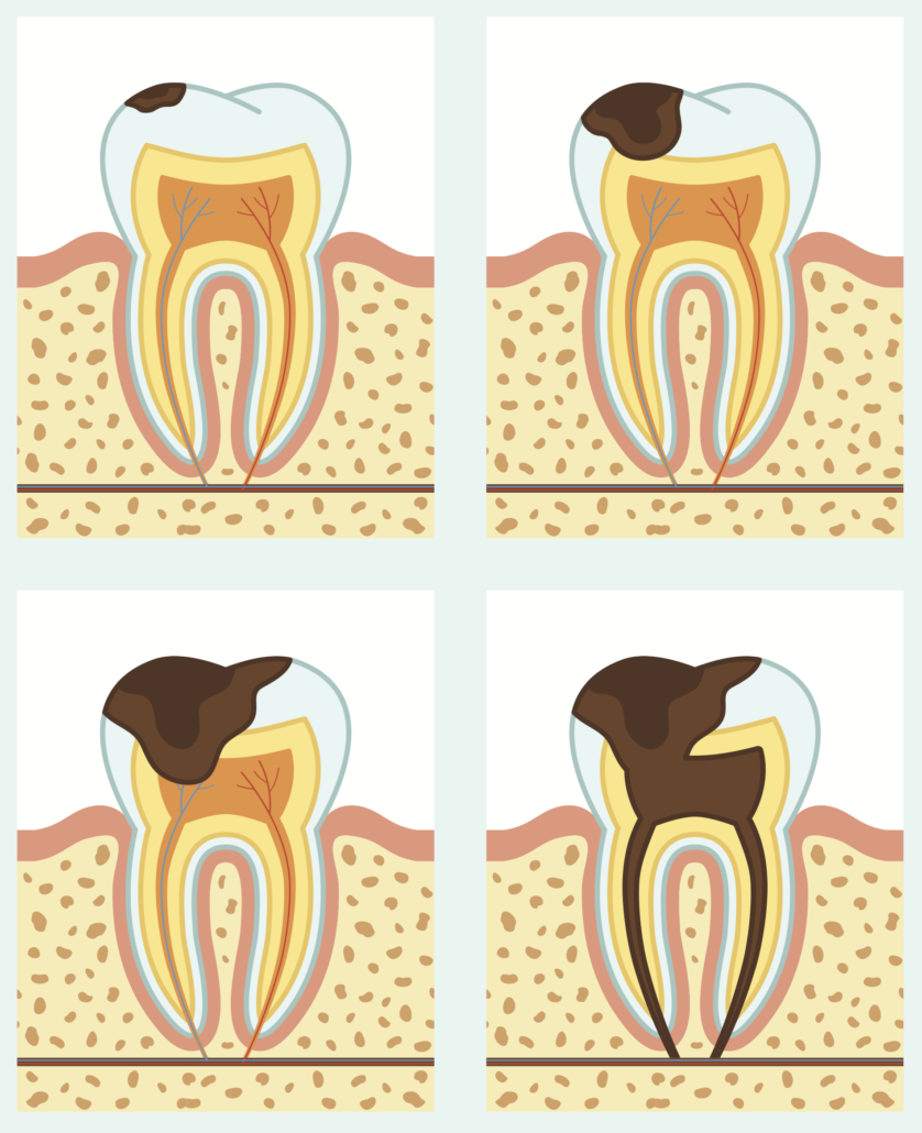 Rotfylling - Ferdig på ett besøk (15. min fra Bergen) | Opitz ...