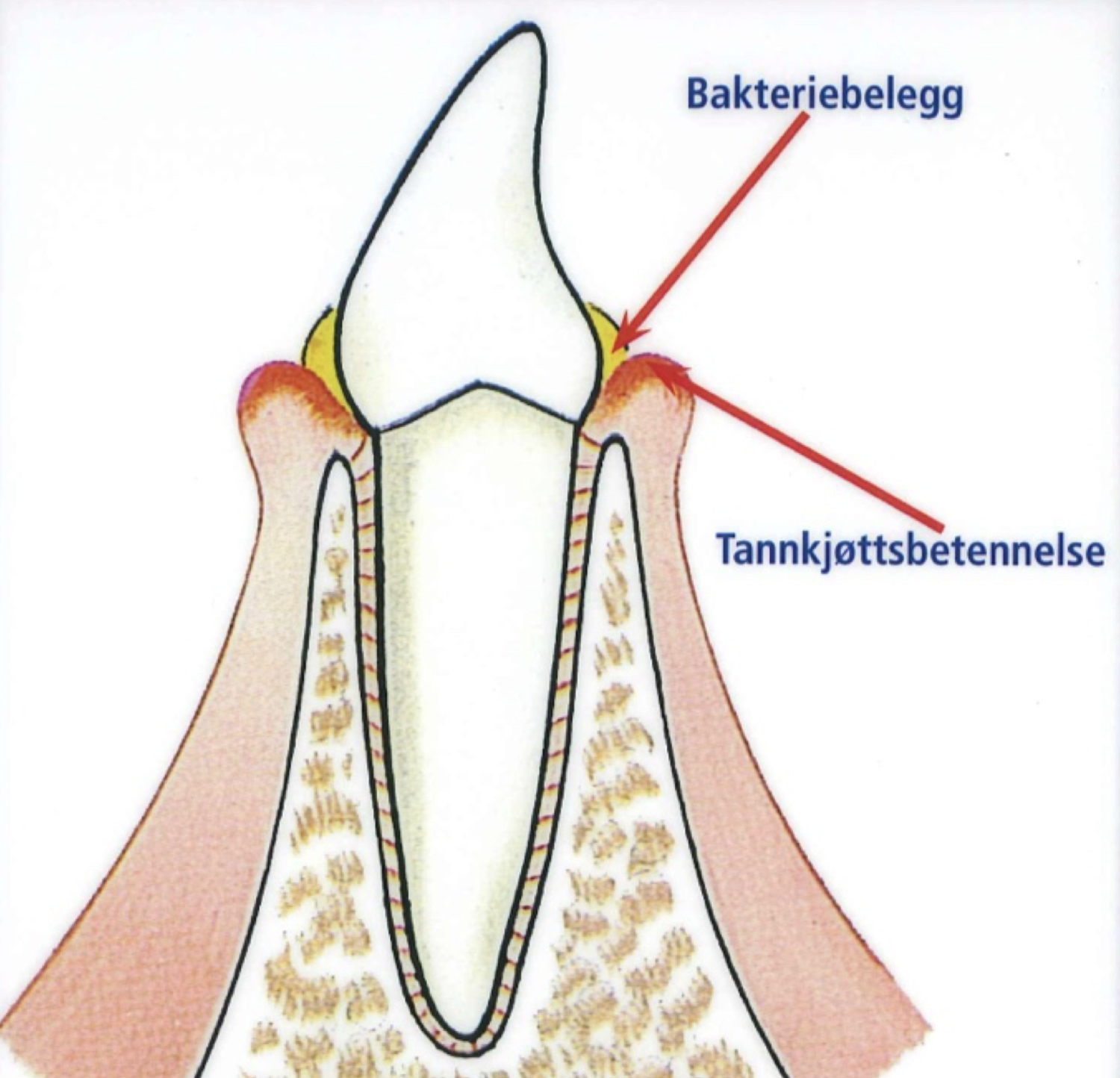 Tannkjøttsykdom – Tannlege på Straume – Opitz Tannhelsesenter